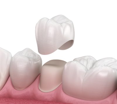 Lost A Dental Crown? | Complete Dental Care | San Jose, CA